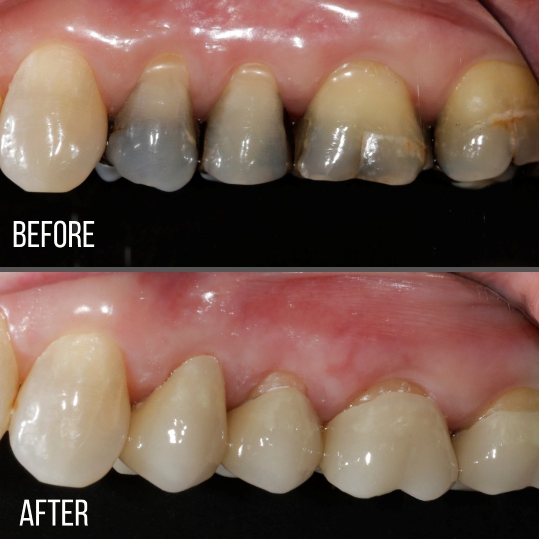 Restorative Dentistry: Preservation At It's Finest... - viosdental.com